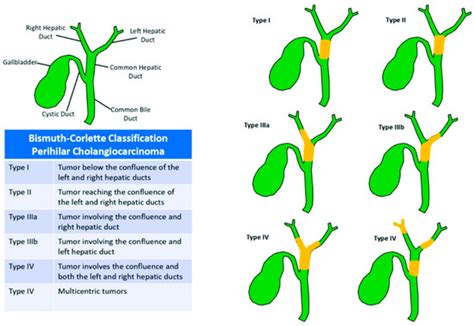 Multi Disciplinary Care Of Hilar Cholangiocarcinoma Review Of Guidelines And Recent Advancements
