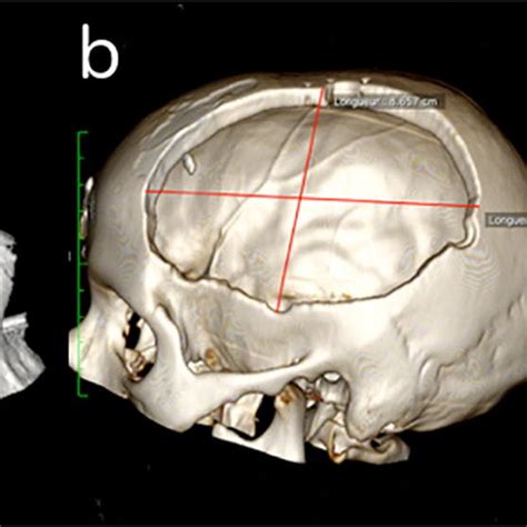 Decompressive Craniectomy Complications Brain Herniation A Download Scientific Diagram