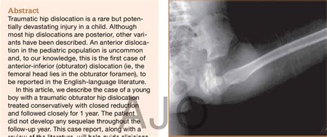 Anteroposterior Radiograph Reveals Obturator Dislocation Of Left Hip