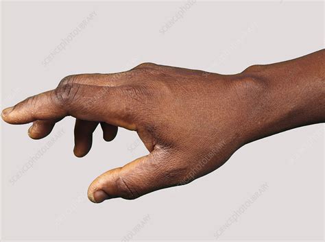 Synovial Cyst Of The Wrist Stock Image C0507449 Science Photo Library