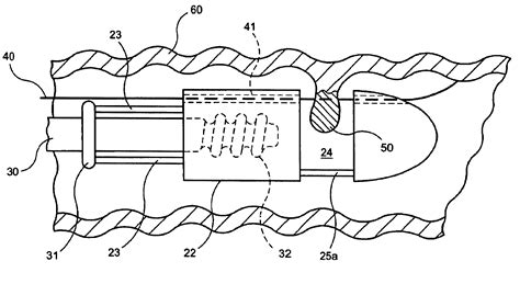 Endoscopic Resection Patented Technology Retrieval Search Results