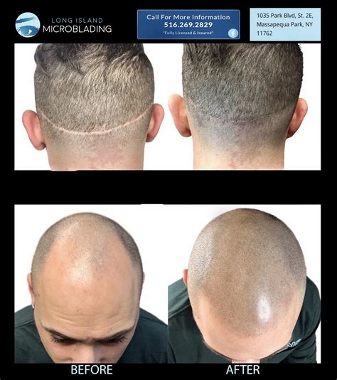 Scalp Micropigmentation Long Island Microblading