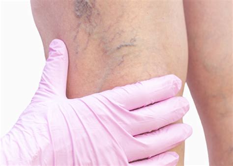 Лечение варикозного расширения вен в Челябинске