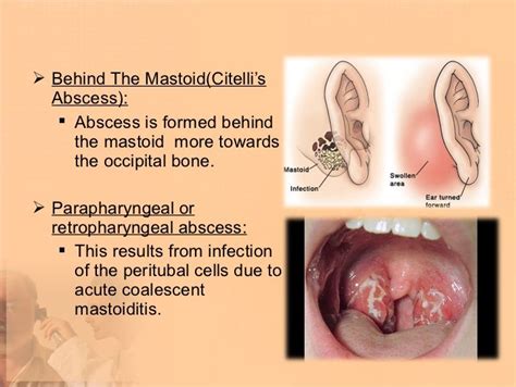 Ascesso Del Citelliinsieme Ventre Posteriore Del Diagnostico