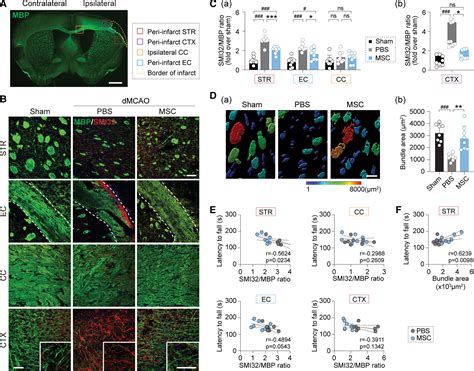 Poststroke Intravenous Transplantation Of Human Mesenchymal Stem Cells