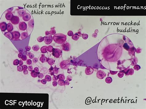 Cryptococcus Neoformans Mucicarmine Stain