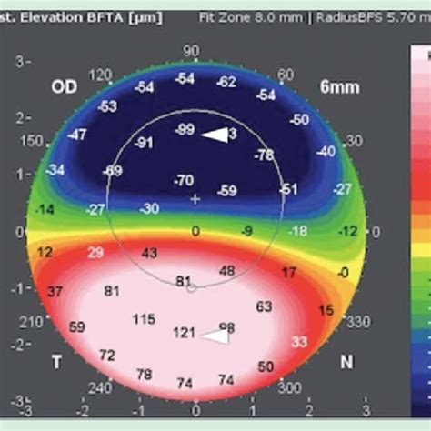 A Four Image Composite Map Of A Patient With Keratoconus Galilei The