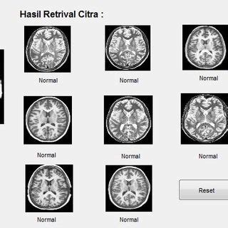 The Image Retrieval Results With Query Image Of Normal By Using