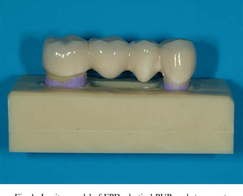 Fixed Partial Denture All Metal