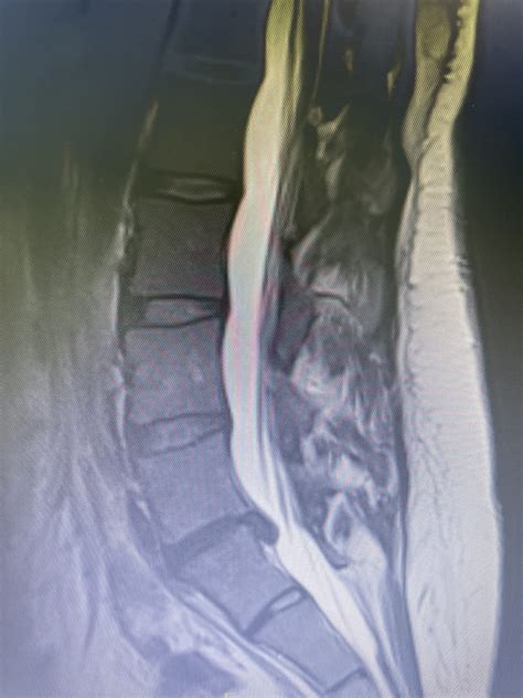 Transitional Lumbar Segment Nspc Brain And Spine Surgery