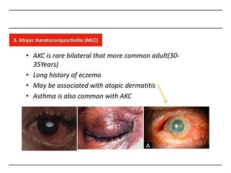 Conjunctivitis Pdf