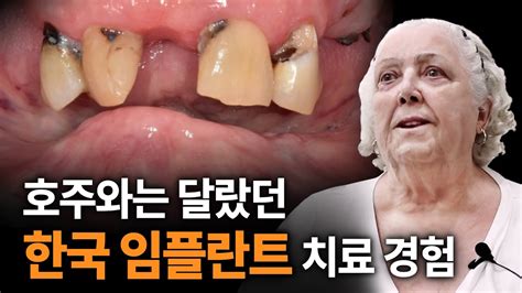 호주에서 오신 환자 분 한국에서 전체 임플란트를 선택한 이유 임플란트 후기 11 Youtube