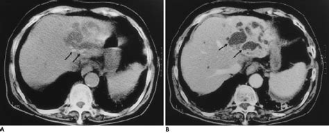 A 68 Year Old Man With Cholangiocarcinoma Associated With Download