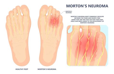 Mortons Neuroma Foot Pain Numbness And Mortons Neuroma Therapies