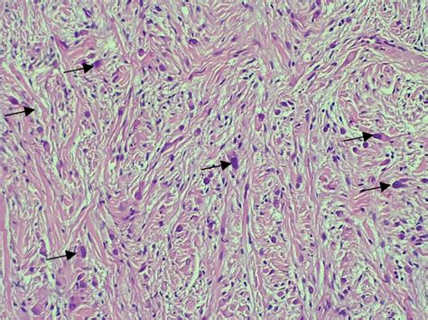 Tumoural Proliferation With Fusiform Cells And Myxoid Stroma That Download Scientific Diagram