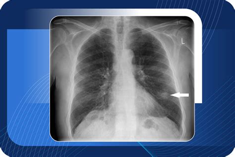 American Thoracic Society What Is A Lung Nodule