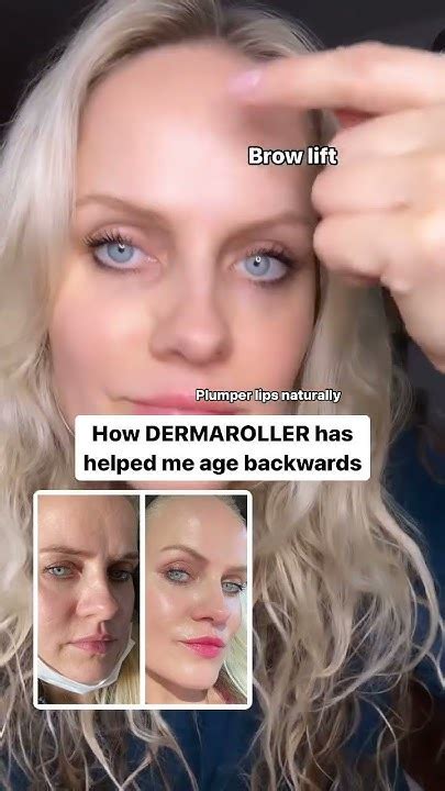 Does Dermaroller Work Before And After Results Youtube