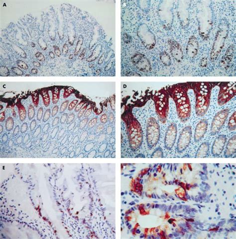 A Low Power View Of Typical Hyperplastic Polyp Showing Lower Crypt Download Scientific