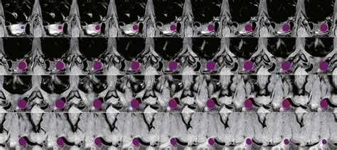 A Deep Learning Framework For Intracranial Aneurysms Automatic