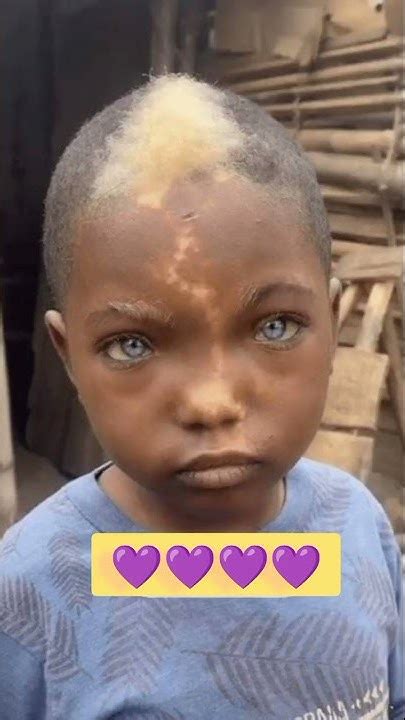 هذا الطفل وُلد بشعر أبيض طبيعي وسط رأسه ، وبعينين زرقاوين وبعلامة تشبه