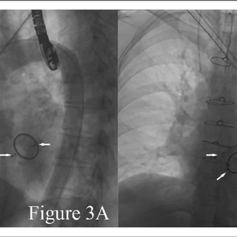 A And B The Regurgitation Of The Aortic Paravalvular Leak Before Download Scientific