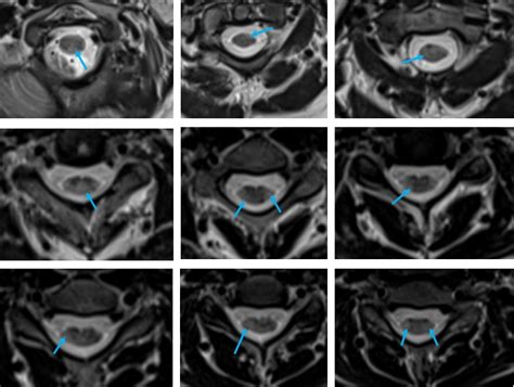multiple sclerosis radiology cases
