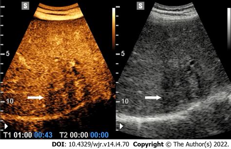 Intrahepatic Cholangiocarcinoma Contrast Enhanced Ultrasound Download Scientific Diagram