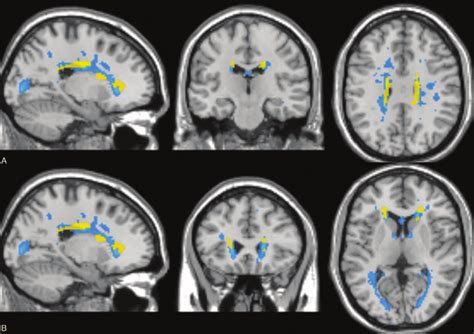 Voxel Based Analysis Results Obtained Using Fractional Anisotropy Maps