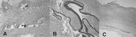 A Echinococcus Alveolaris Cysts Showing Granulomatous Reaction Inside