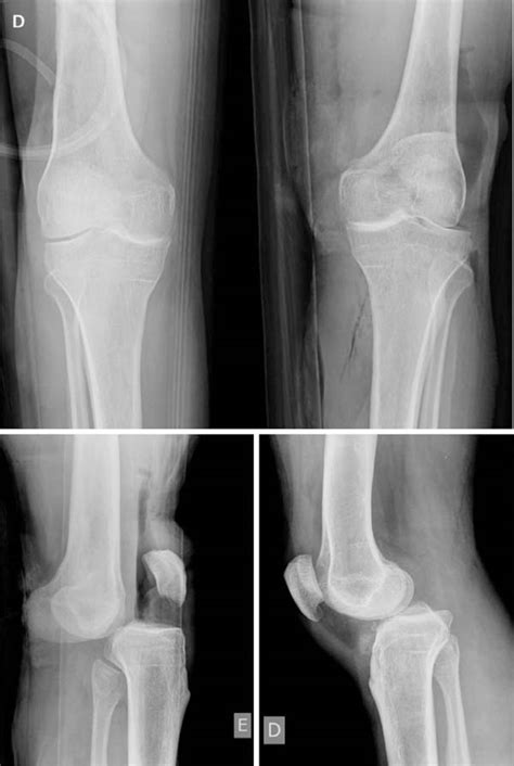 Anterior Knee Dislocation