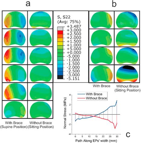 Normal Stress Distribution Resulted From Finite Element Analysis On