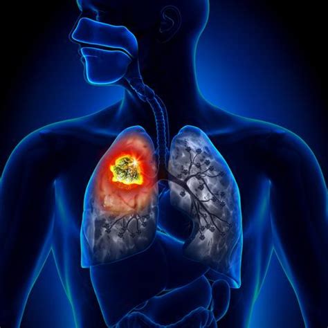Stage 3 Cancer Treatments Pintas And Mullins