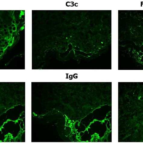 Biopsy Of Left Thigh Skin Specimen Immunofluorescence Staining Iga