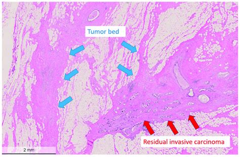 Low Power View Of A Post Treatment Breast Surgical Specimen After Download Scientific Diagram