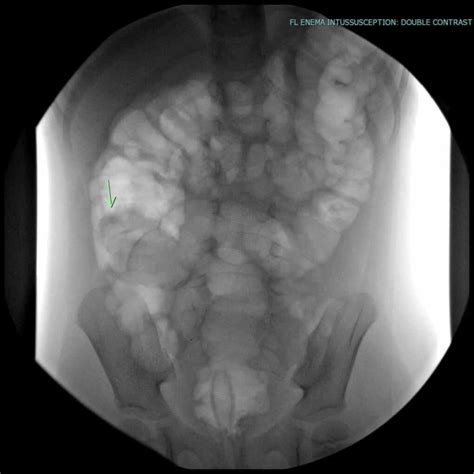 Intussusception Uams Department Of Radiology