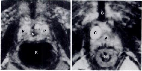Lateral Prostatic Cyst Transverse Mr Image 2000 50 Cyst Arrows In Download Scientific