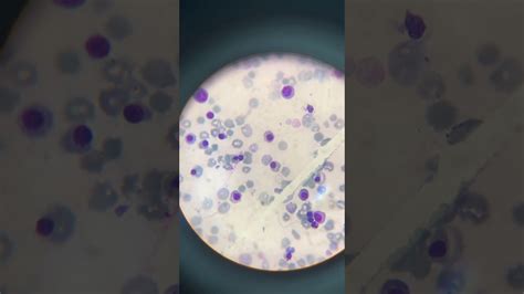 Cálculo Para Correção De Leucócitos A Partir Da Contagem De Eritroblastos Youtube