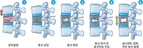 압박골절 서재곤링커병원