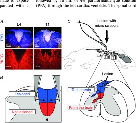 Lesion Of The Dorsal Column Medial Lemniscus Dcml Pathway Leaves The