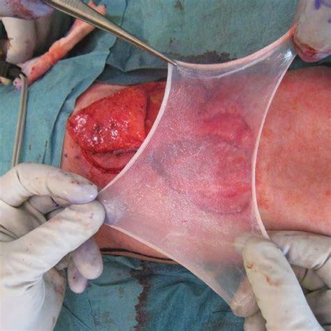 Autologous Amnion Is Used As A Dural Graft With Its Epithelium Side