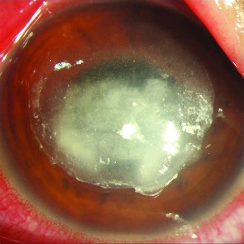 A Case Of Grade 2 Diffuse Lamellar Keratitis Post Laser In Situ