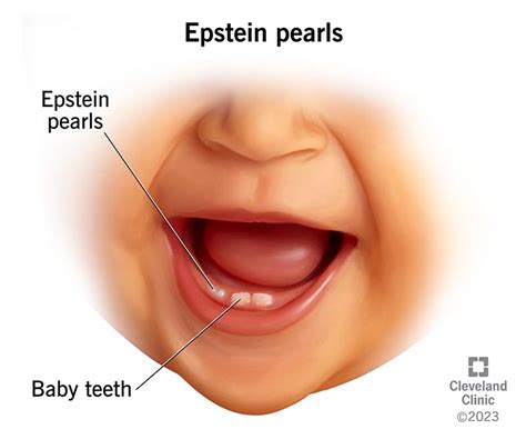 Epstein Pearls Causes And Treatment