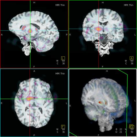 Results Of Preliminary Experiments With Cerebral DSA Images First And Download Scientific