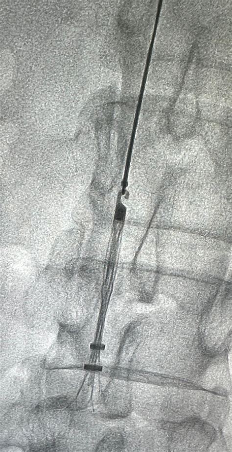 What Is An Ivc Filter