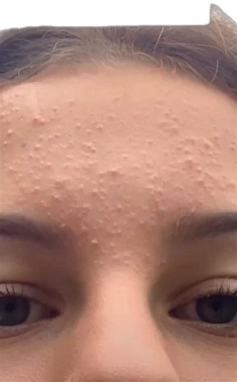 How To Get Rid Of Acne Fast Video Clear Skin Tips Pretty Skin Care Beginner Skin Care Routine