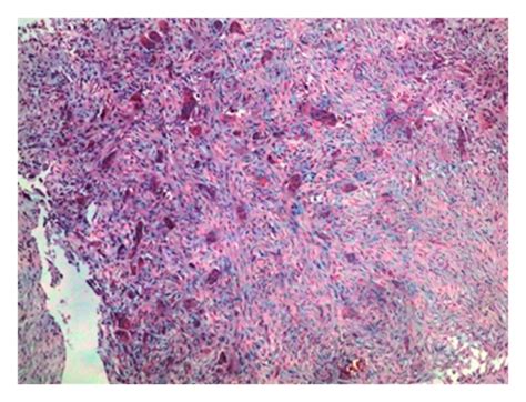 Primary Hyperparathyroidism Histology