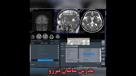 بخش دوم آموزش عملی ام آر آی مغز Brain Mri Youtube