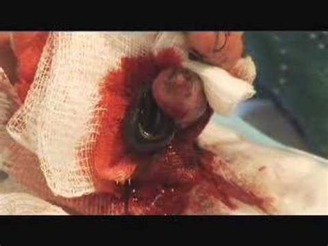 BLINDED BY SCIENCE Plastic Surgery Re Attachment YouTube