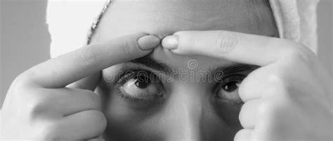 Pustule Acne Close Up Pimple On Female Skin Stock Image Image Of