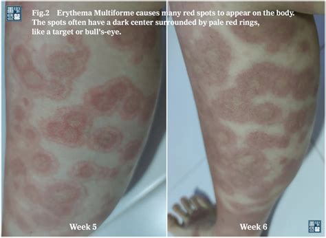 Erythema Multiforme Or Urticaria Vasculitis Different Paths Lead To The Same Destination 殊途同归